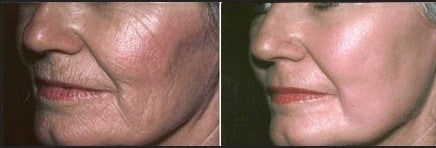 Janssen Dual Ultra Wave IPL – Janssen Lasers & Beauty Equipment